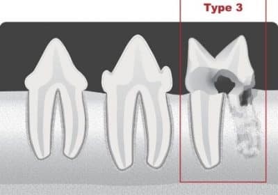 Tandresorptie bij de kat – Dierenkliniek Balkbrug – Nieuwleusen